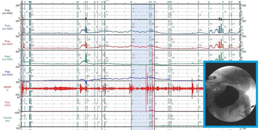 The Role and Significance of Urodynamics Testing in Urology
