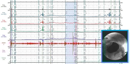 Video Urodynamics vs. Traditional Urodynamics: A Comparison