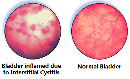 Urodynamics and Interstitial Cystitis